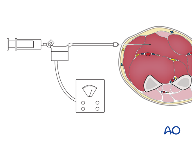 Compartment syndrome