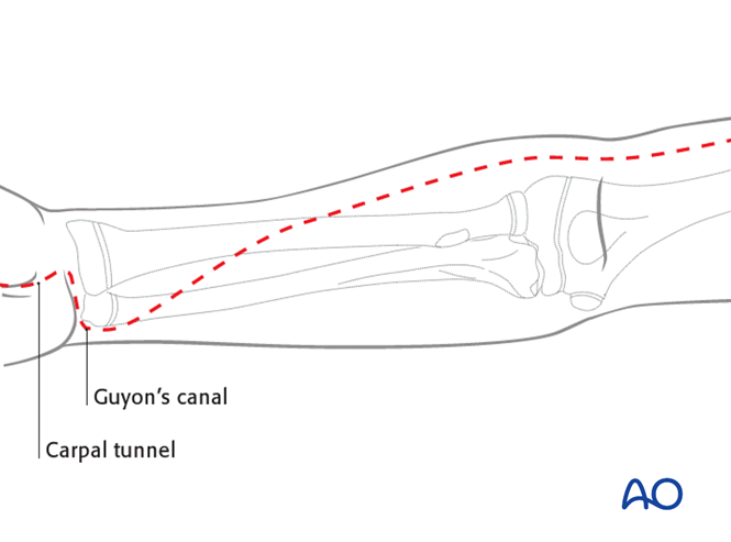 Compartment syndrome