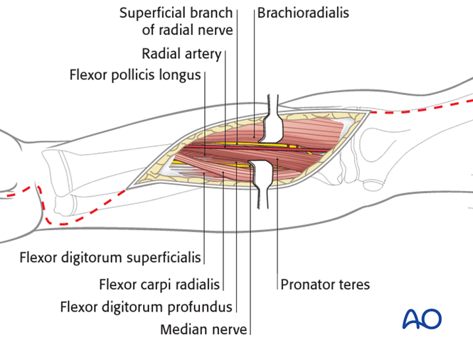 Compartment syndrome