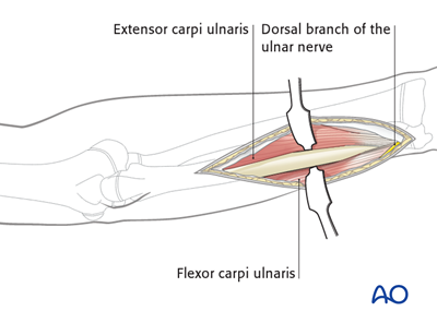 Compartment syndrome