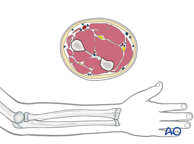 Closed reduction; cast fixation with/without wedging for Both bones ...
