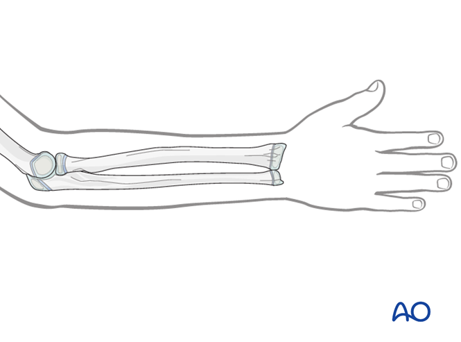 Safe zones for pin placement in the pediatric radius