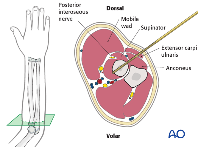 Safe zones for pin placement in the pediatric radius