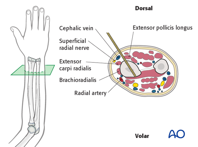External fixation for Both bones, combination of radial and ulnar fracture