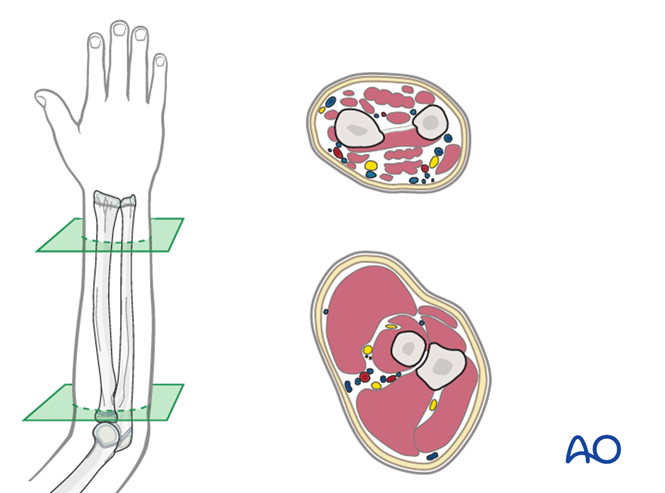 External fixation for Both bones, combination of radial and ulnar fracture