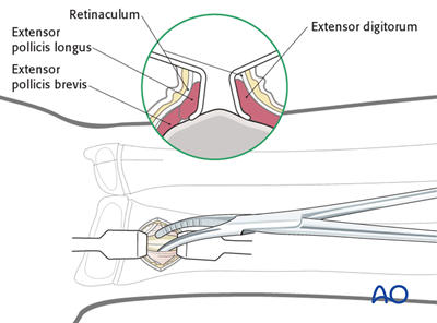 ESIN entry points (pediatric radius)