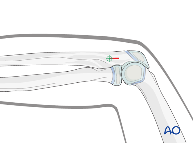 ESIN entry points (pediatric ulna)