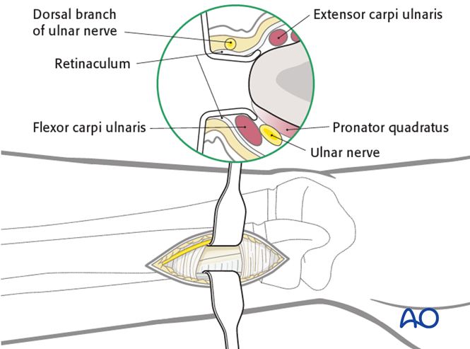 ESIN entry points (pediatric ulna)