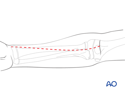 Anterior (Henry) approach to the pediatric radius