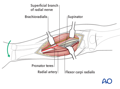 Anterior (Henry) approach to the pediatric radius
