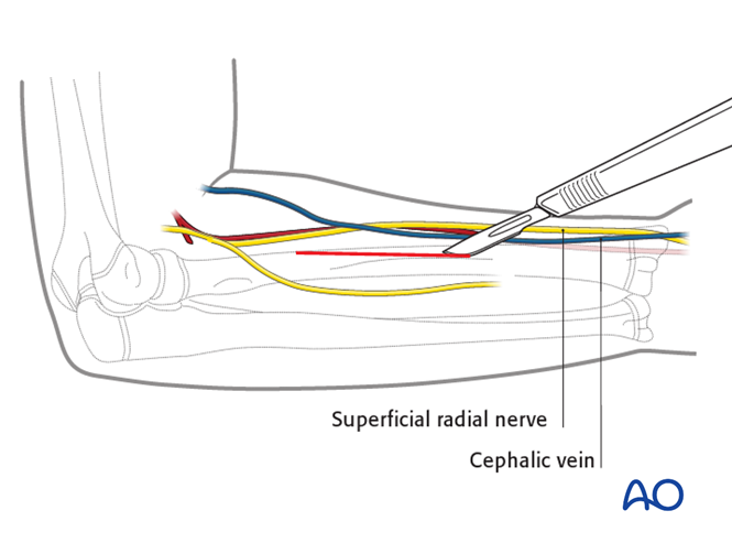 Posterolateral (Thompson) approach to the pediatric radius