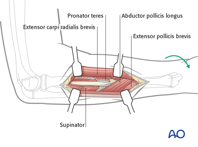 Posterolateral (Thompson) approach to the pediatric radius