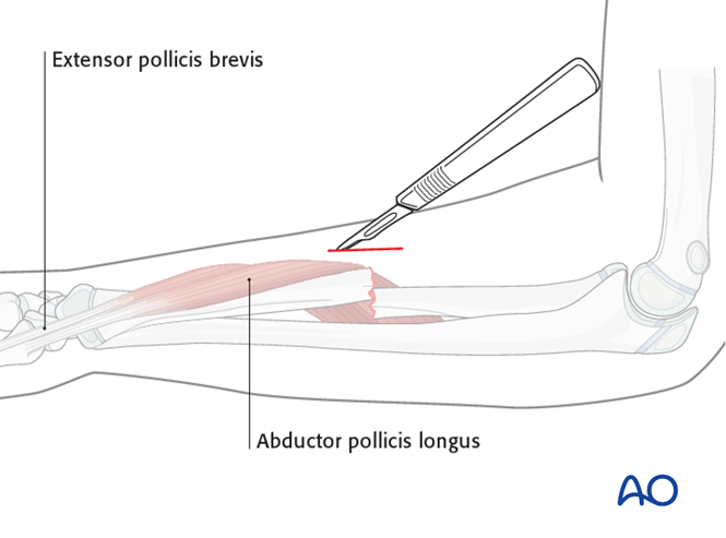 Posterolateral (Thompson) approach to the pediatric radius