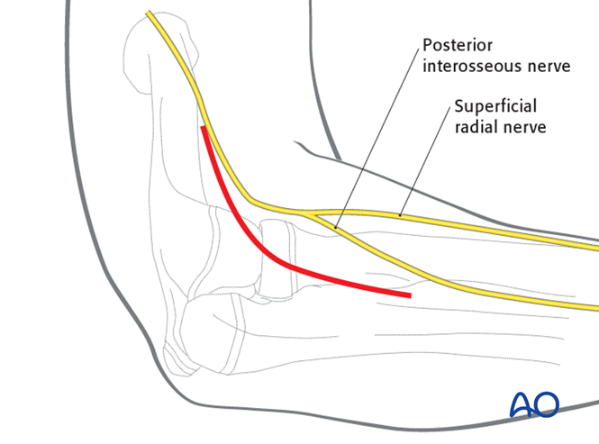 Lateral (Kocher) approach to the pediatric proximal radius