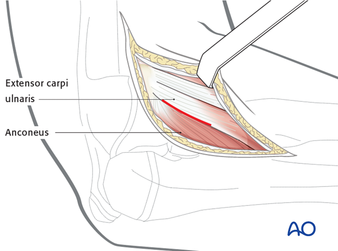 Lateral (Kocher) approach to the pediatric proximal radius