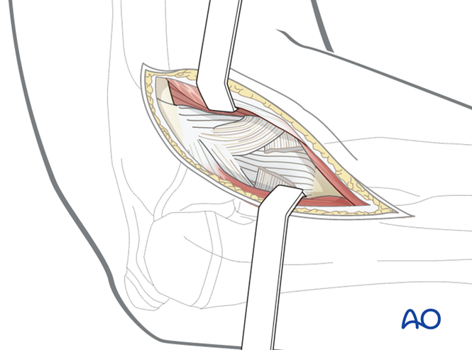 Lateral (Kocher) approach to the pediatric proximal radius