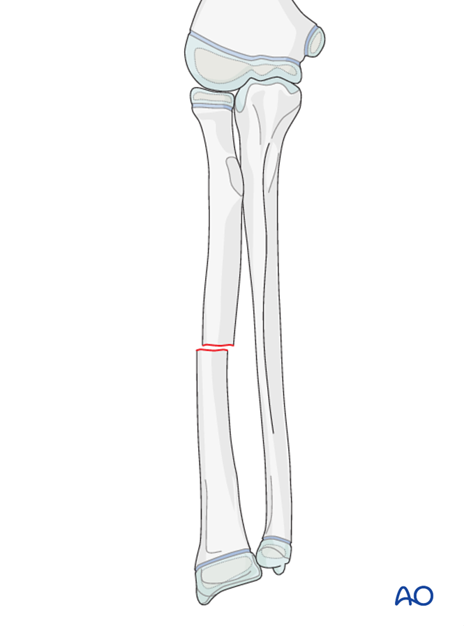 Radius, complete transverse, simple
