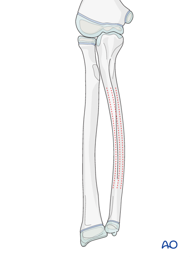 Ulna, bowing