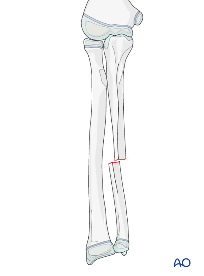 Ulna, complete transverse, simple