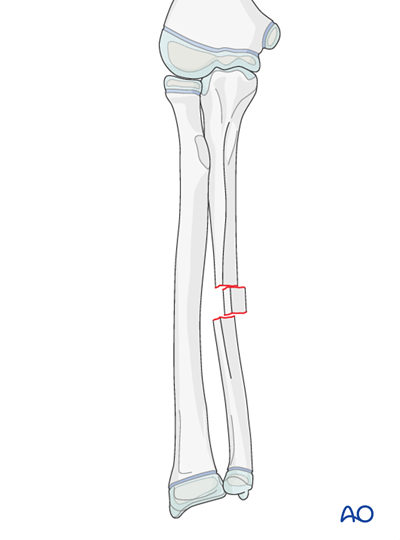 Ulna, complete transverse, multifragmentary