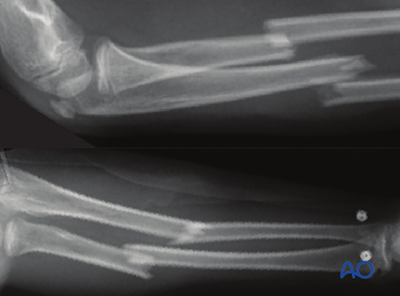 Both bones, combination of radial and ulnar fracture