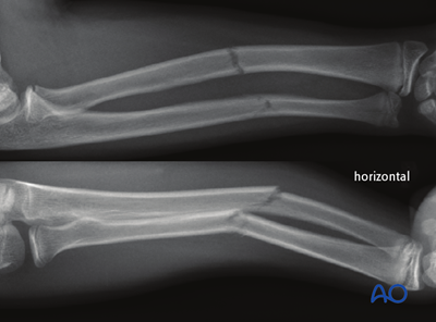 Both bones, combination of radial and ulnar fracture