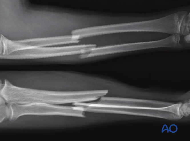 Both bones, combination of radial and ulnar fracture