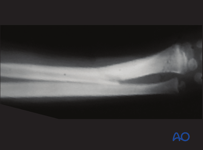 Radius, complete oblique or spiral