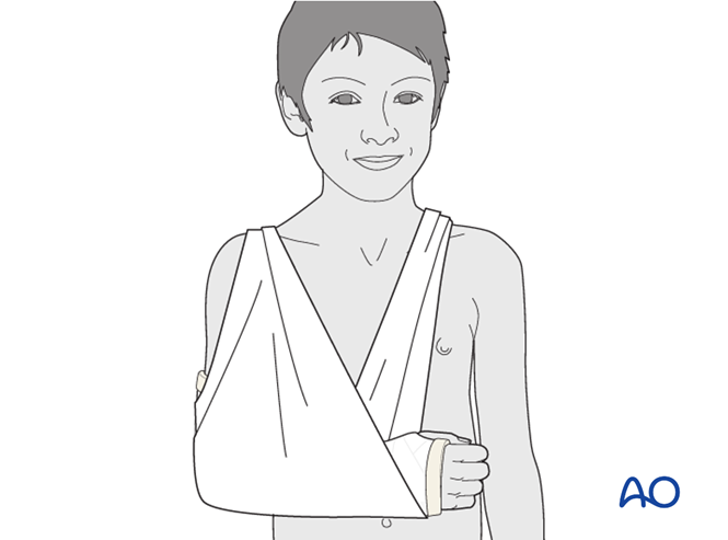 Closed reduction; cast fixation with/without wedging for Both bones ...
