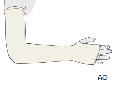 Closed reduction; cast or splint fixation for Radius, complete oblique ...