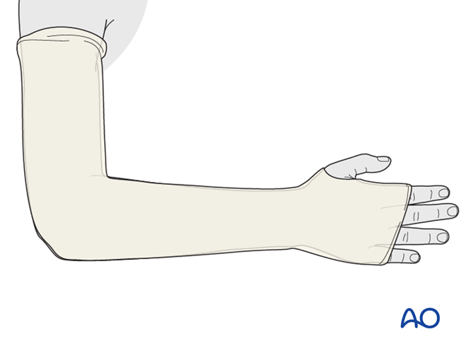 Closed reduction; cast fixation with/without wedging for Both bones ...
