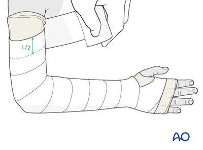 Closed reduction; cast or splint fixation for Radius, complete oblique ...