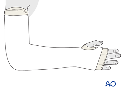 Cast or splint fixation without reduction for Ulna, bowing
