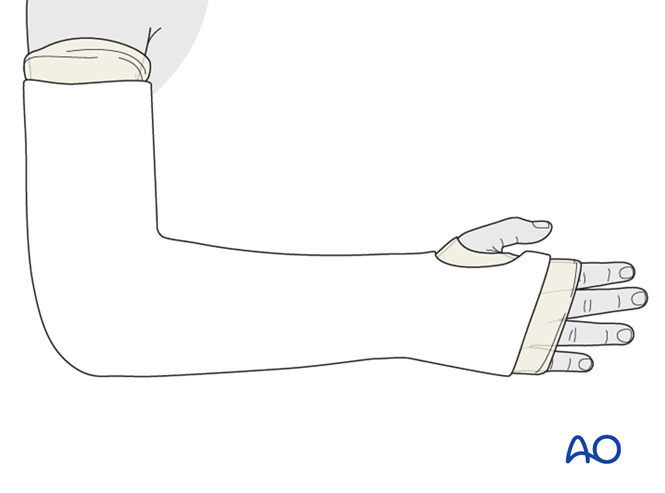 Closed reduction; cast fixation with/without wedging for Both bones ...