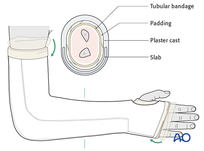 Closed reduction; cast fixation with/without wedging for Both bones ...