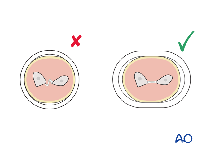 Closed reduction; cast fixation with/without wedging for Both bones ...
