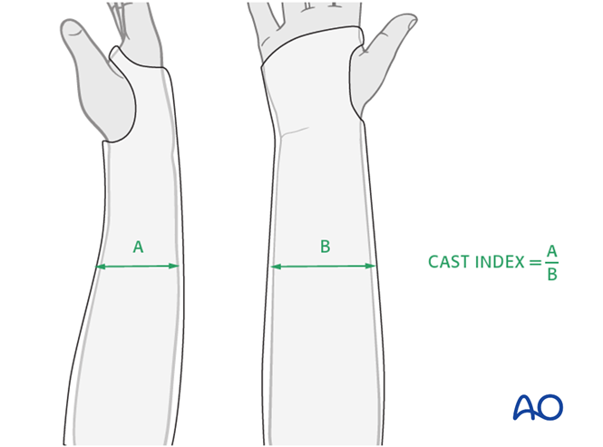 Closed reduction; cast fixation with/without wedging for Both bones ...
