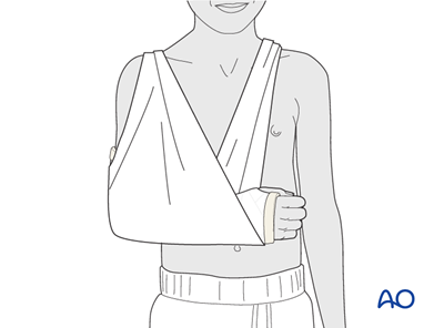 Closed reduction; cast fixation with/without wedging for Both bones ...