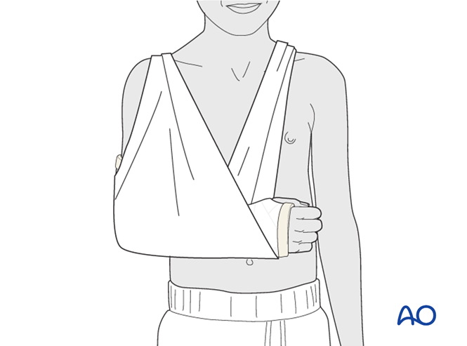 Closed reduction; cast fixation with/without wedging for Both bones ...