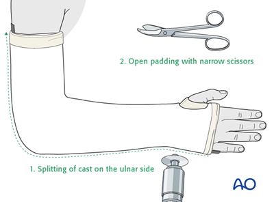 Closed reduction; cast fixation with/without wedging for Both bones ...