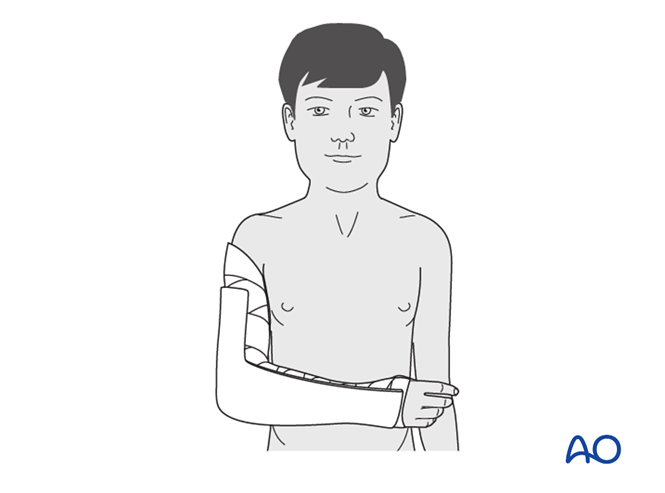 Closed reduction; cast or splint fixation for Radius, complete oblique ...