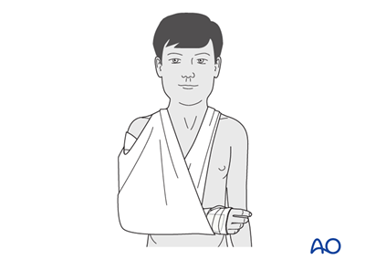 Closed reduction; cast or splint fixation for Radius, complete oblique ...