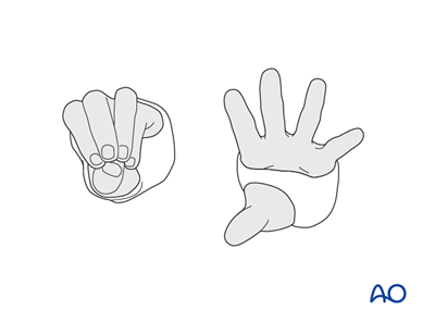 Closed reduction; cast fixation with/without wedging for Both bones ...