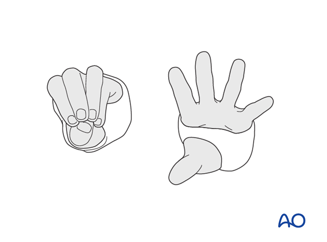 Closed reduction; cast fixation with/without wedging for Both bones ...