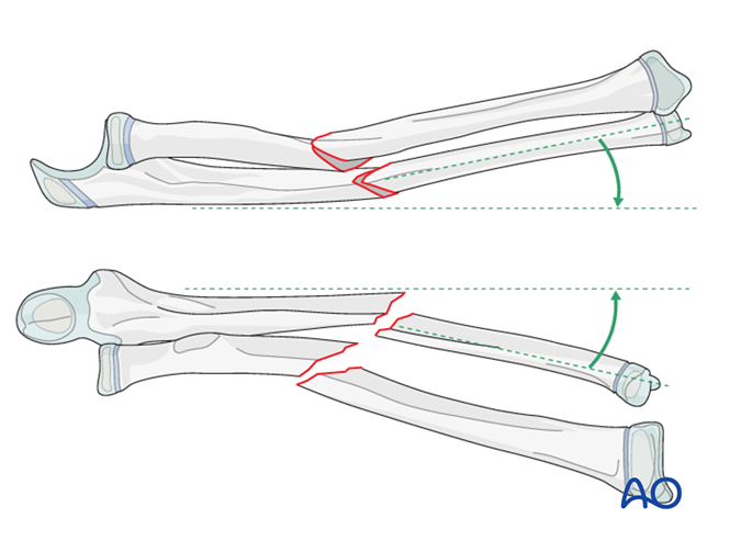 Closed reduction; cast fixation with/without wedging for Both bones ...