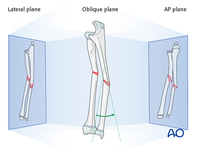 Closed reduction; cast fixation with/without wedging for Both bones ...