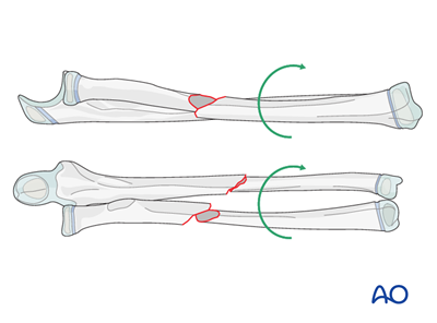 Closed reduction; cast fixation with/without wedging for Both bones ...