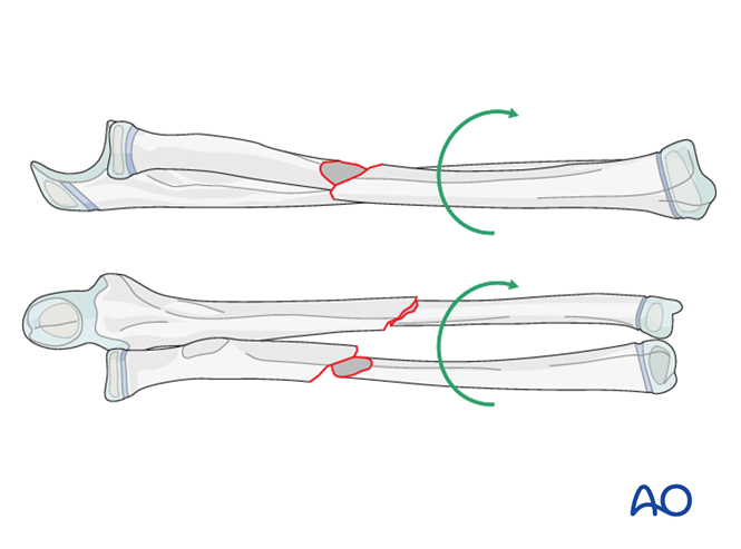 Closed reduction; cast fixation with/without wedging for Both bones ...