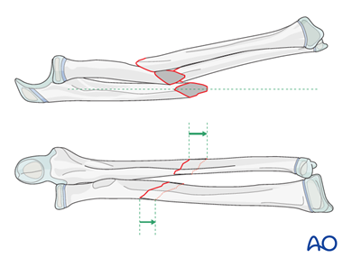 Closed reduction; cast fixation with/without wedging for Both bones ...