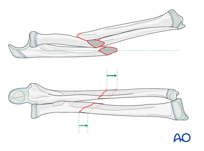 Closed reduction; cast fixation with/without wedging for Both bones ...
